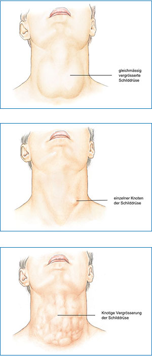 Dr. Iris Wolf-Kohlmeier - Kropf / Schilddrüsenknoten / Struma in Graz